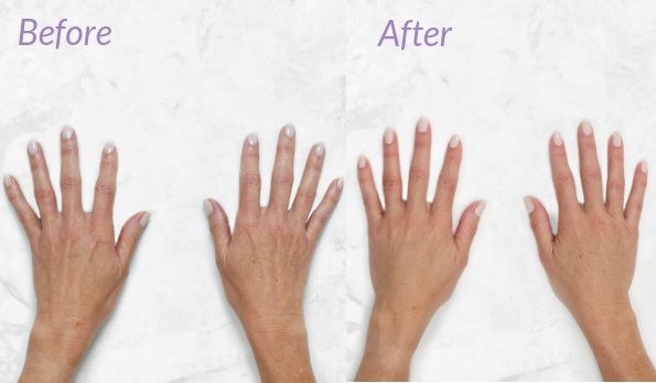 Restylane Lyft Hand Filler | Aesthetica Medical Spa