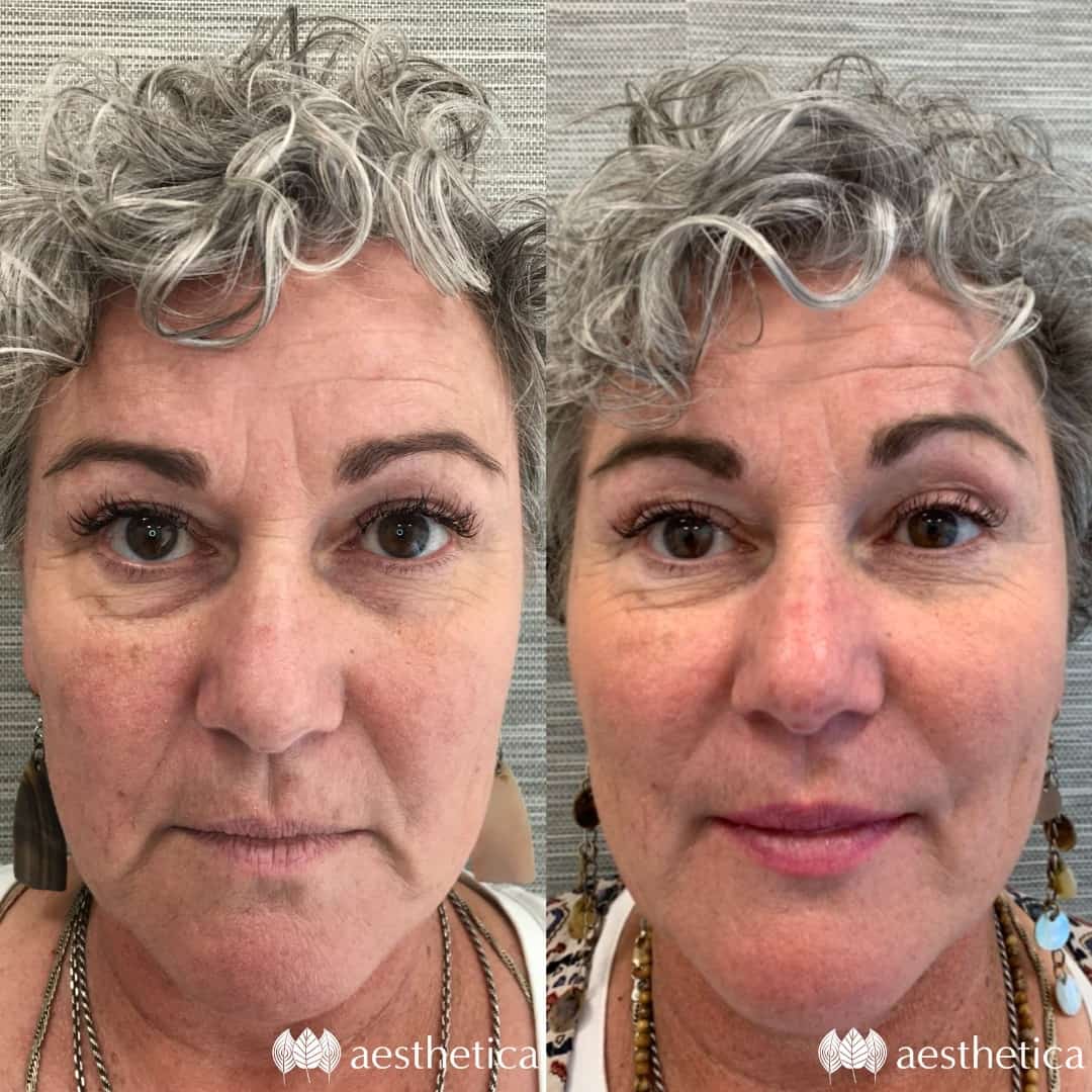 The RHA Collection of Fillers | Aesthetica Medical Spa