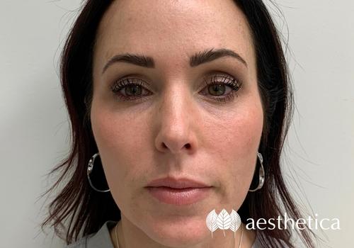 Frax Fractional Laser Treatment | Aesthetica Medical Spa