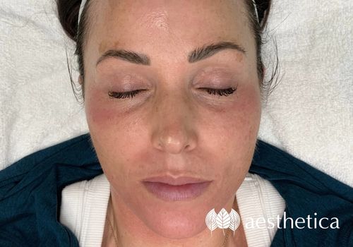 Frax Fractional Laser Treatment | Aesthetica Medical Spa