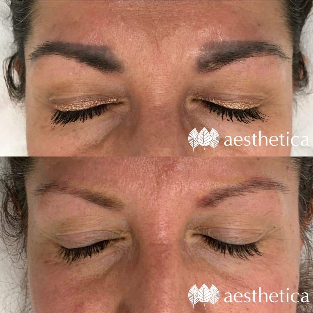 Microblading Removal Near Me | Aesthetica Medical Spa