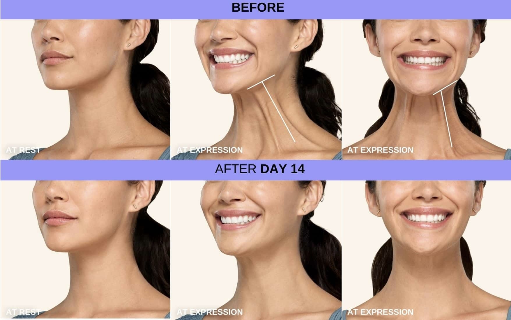 Nefertiti Botox Neck Lift | Aesthetica Medical Spa